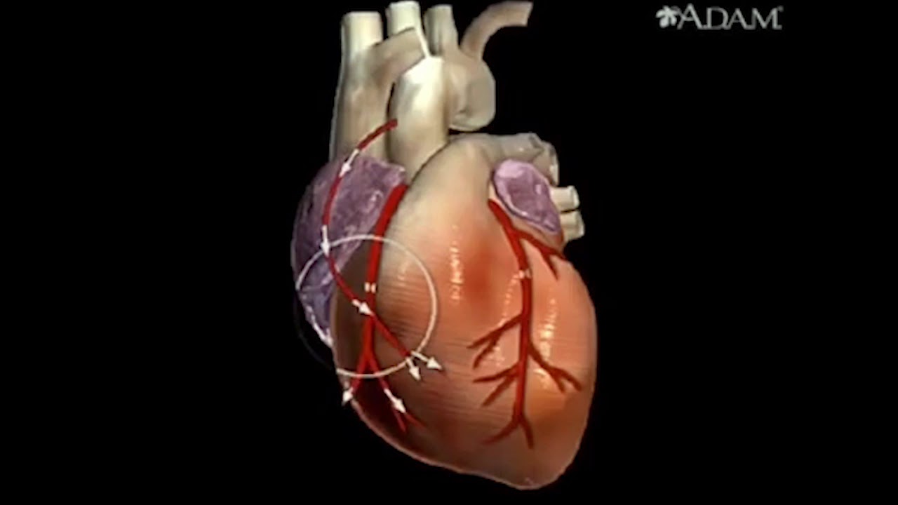 HEART BYPASS - YouTube