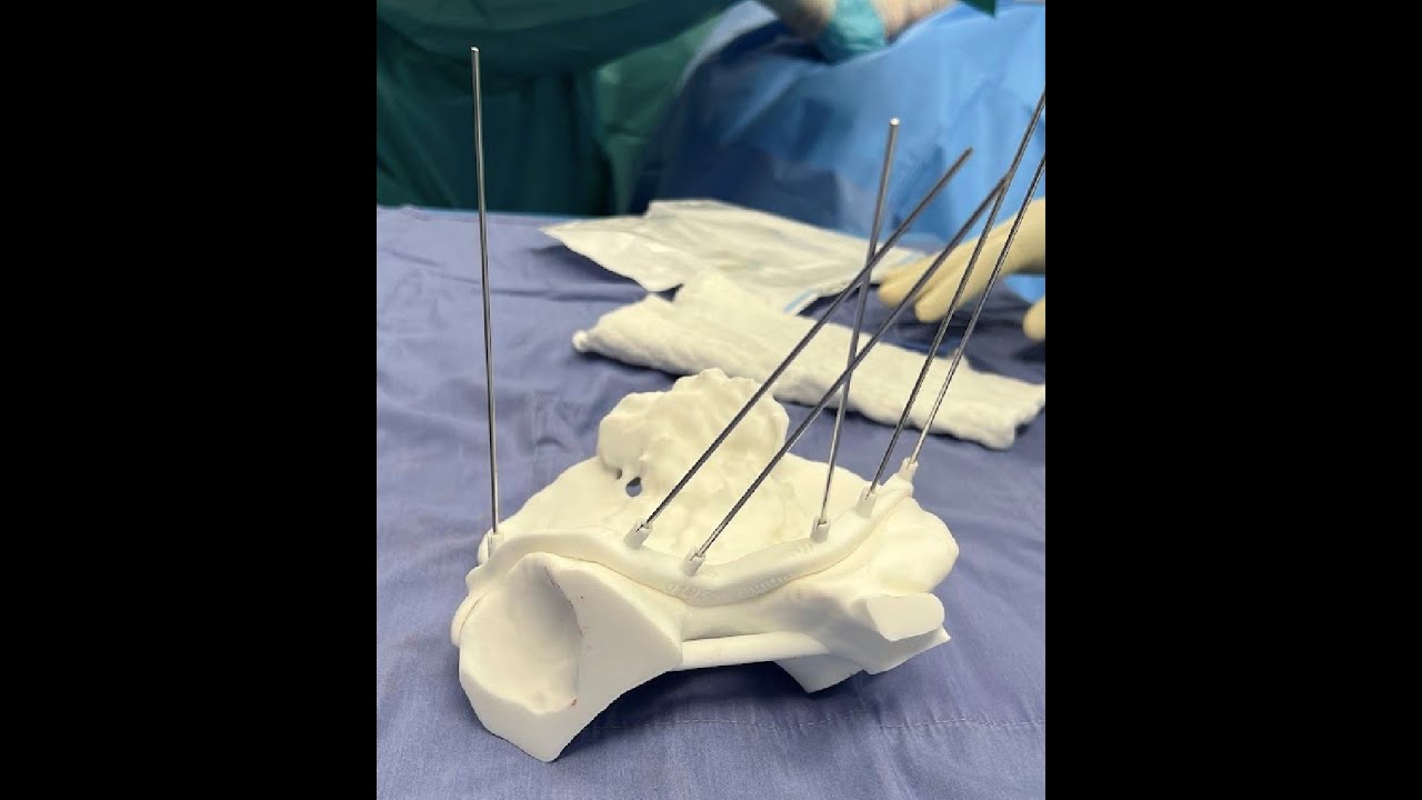 Type 4 pelvic resection using 3 D printing technology, inverted U shape ...