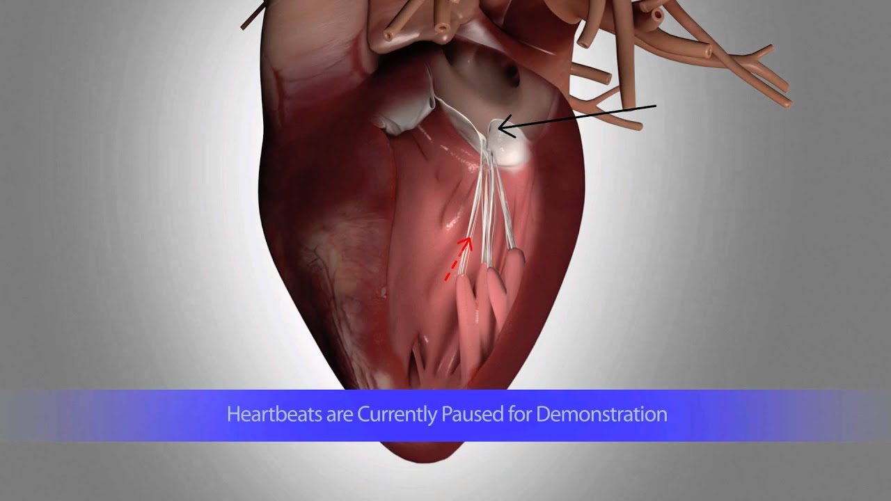 Harpoon Medical - YouTube