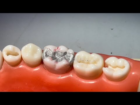 Class II (MOD) amalgam restoration (part2) - YouTube