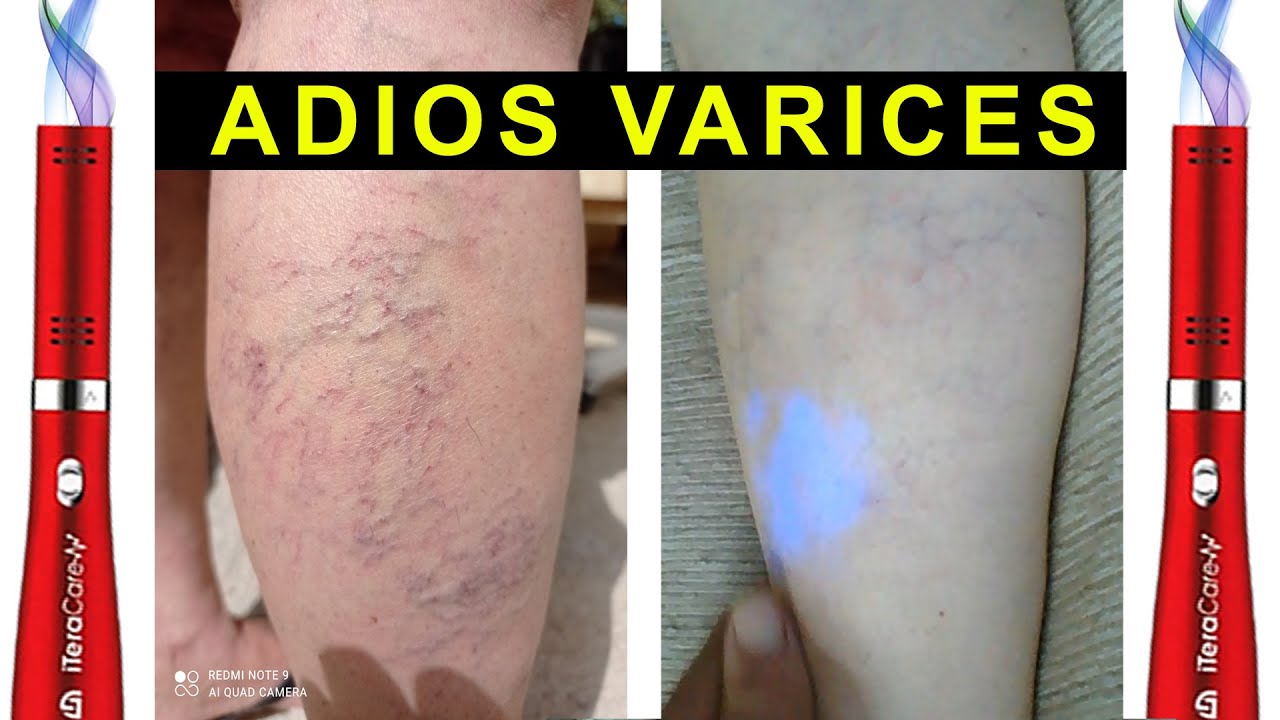 🌟PROCESO PARA ELIMINAR VARICES CON ITERACARE - YouTube