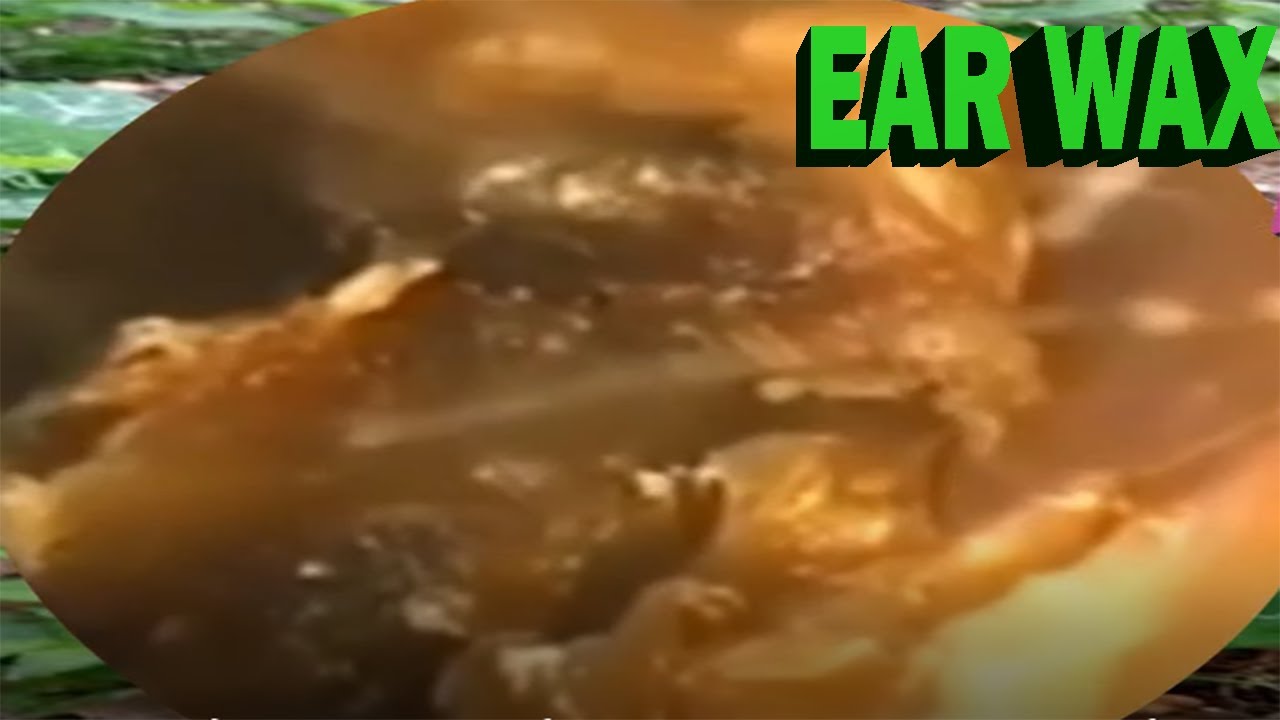 EIMPACTED EAR WAX STONY HARD REMOVAL ear wax remove- Spa-Part384 - YouTube