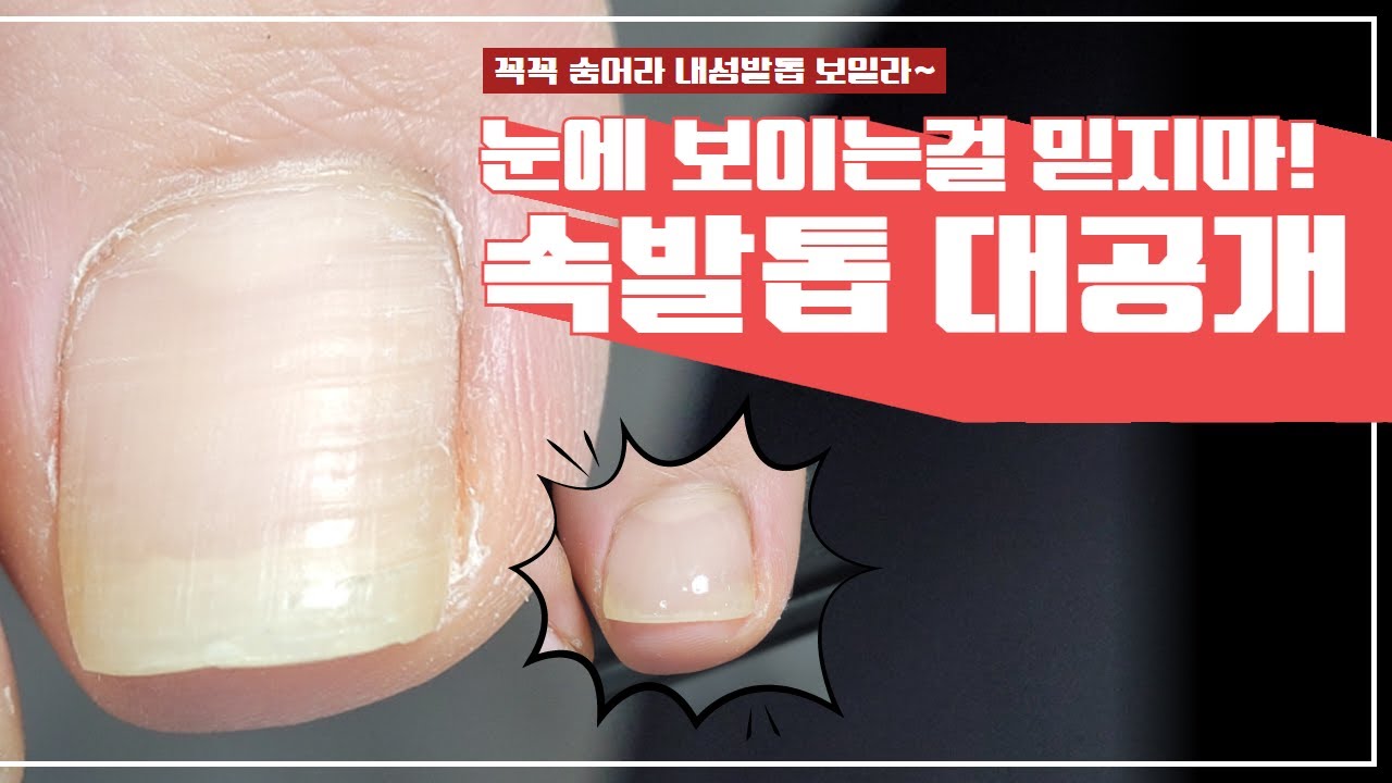 [특허관리] 속발톱 꺼내기 / Unfolding hidden Toenail Edge 내성발톱 - YouTube