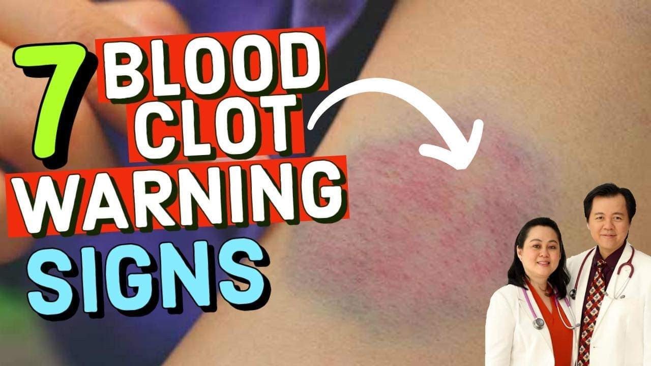 7 Blood Clot Warning Signs: Alamin Ito - By Doc Willie Ong - YouTube