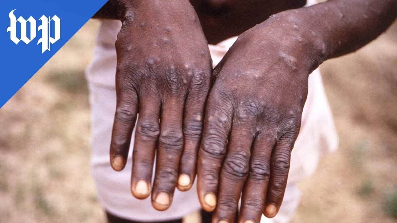 What to know about monkeypox - YouTube