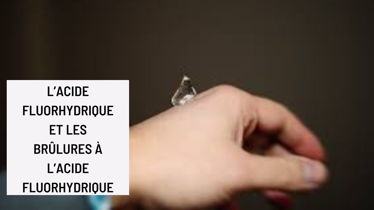 l’acide fluorhydrique et Les brûlures à l’acide fluorhydrique - YouTube