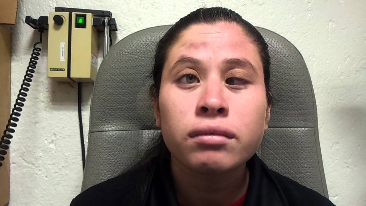 Estrabismo - YouTube