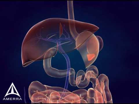 Whipple Procedure - 3D Medical Animation