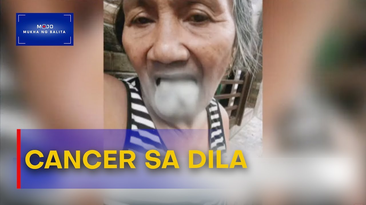 Bukol sa dila ng isang lola sa Palawan, oral cancer na pala! | # ...