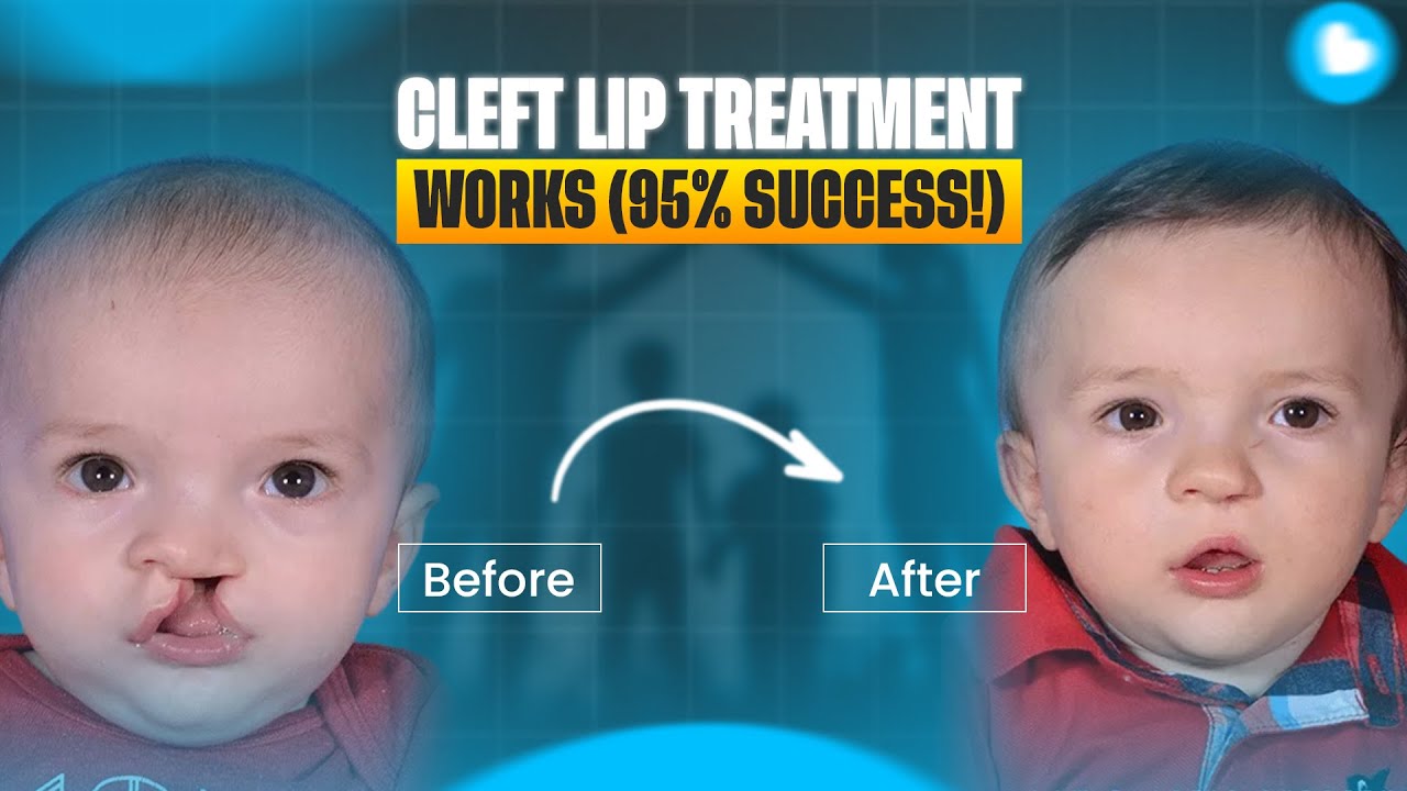 How Cleft Lip Surgery Is Performed | Complete Guide to Repair ...