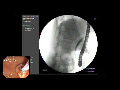 ERCP ; Transpancreatic precut EST and CBD stones removal. - YouTube