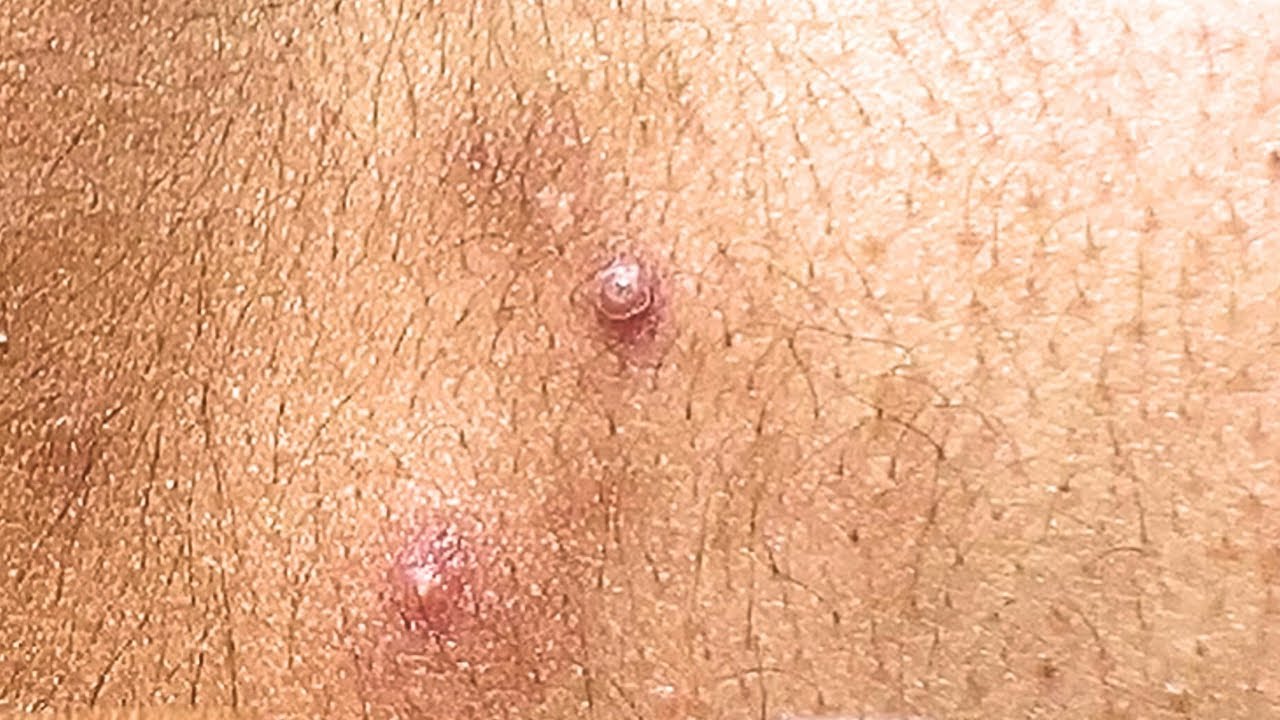 Extraction of back pimples: Relax with bye pimple💜 - YouTube