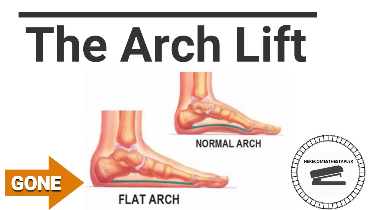 COMBATTING FLAT FEET WITH THE ARCH LIFT - YouTube