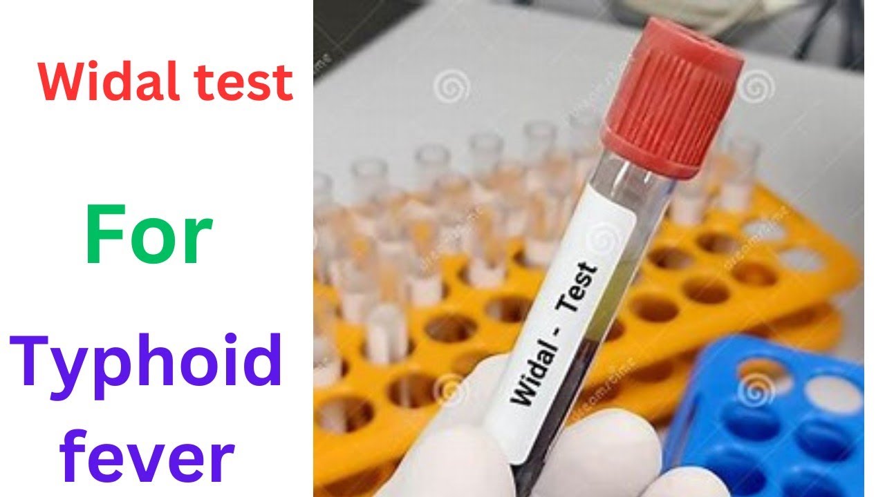 Laboratory diagnosis of typhoid fever.How typhoid test is done. - YouTube