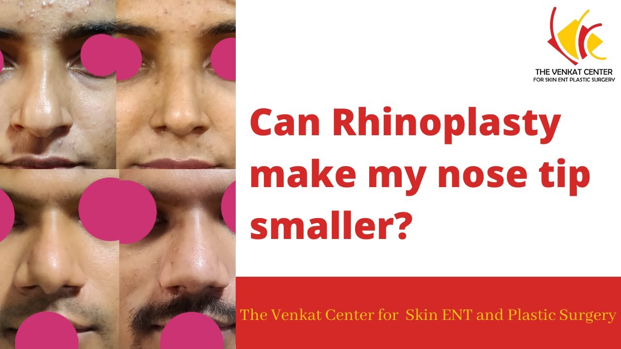 Rhinoplasty |Nose tip Sharpening Procedure Explained| Patient ...