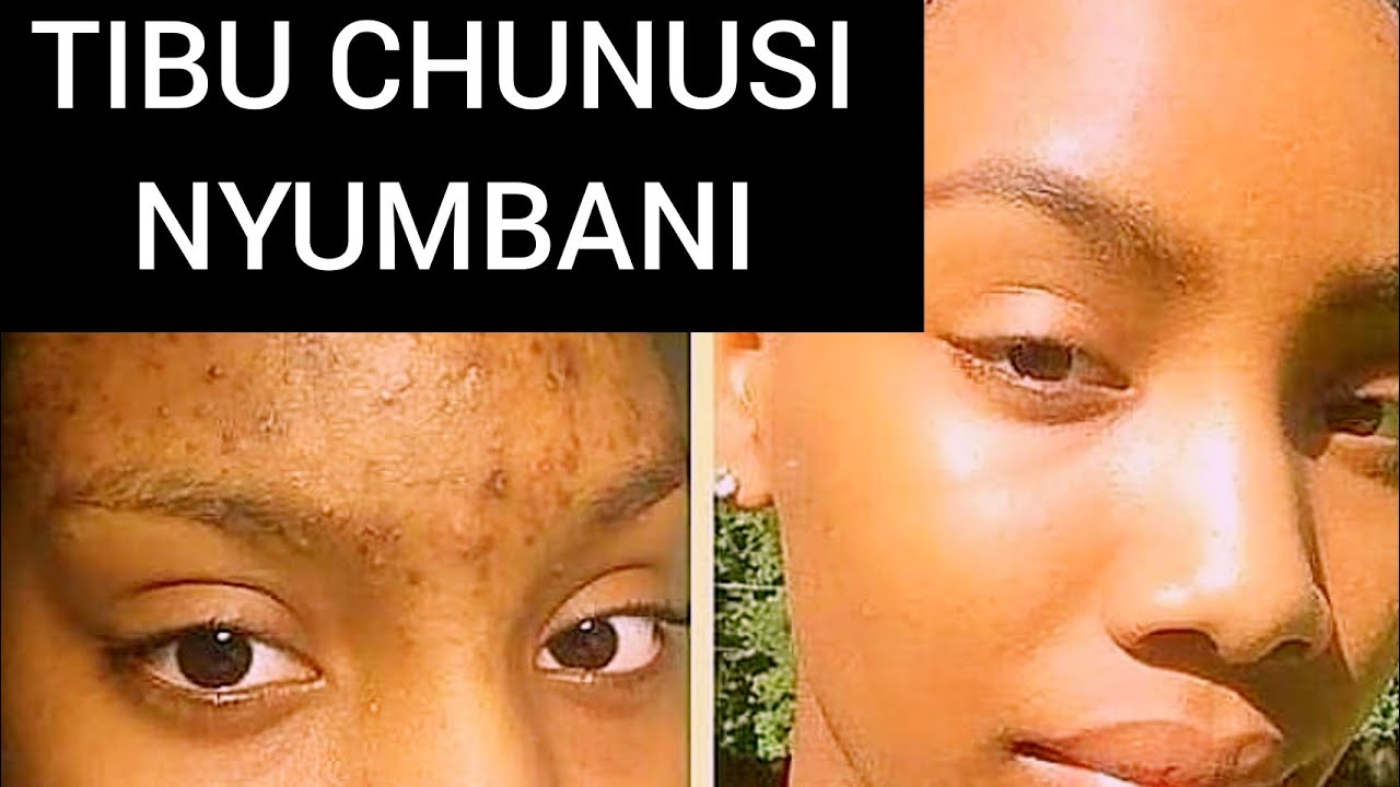 Jinsi ya KUONDOA CHUNUSI na MABAKA usoni kwa HARAKA. - YouTube