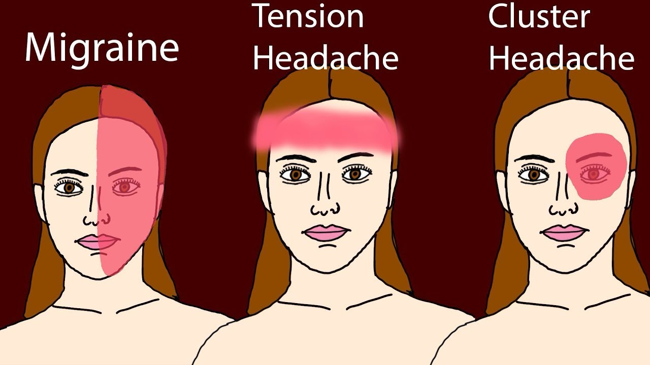 Approach to headache: migraine, tension, cluster ..etc - YouTube