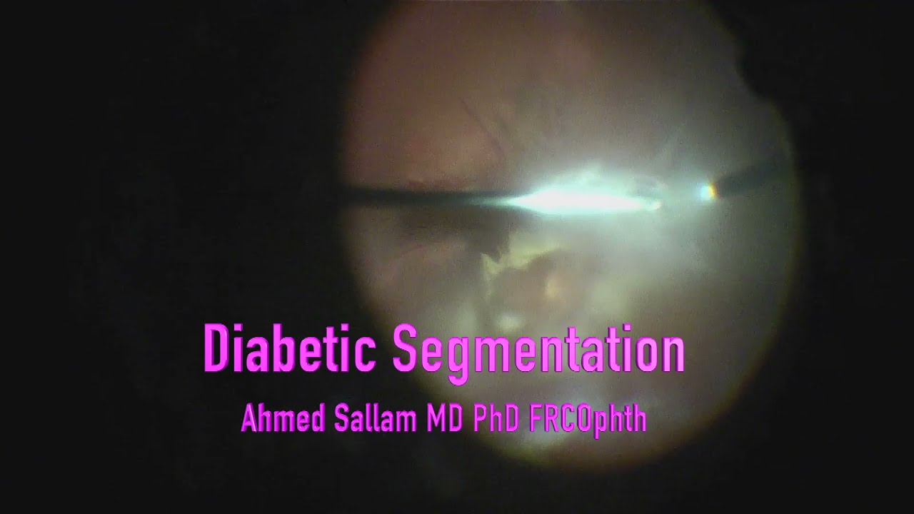 Diabetic Membrane Segmentation - YouTube