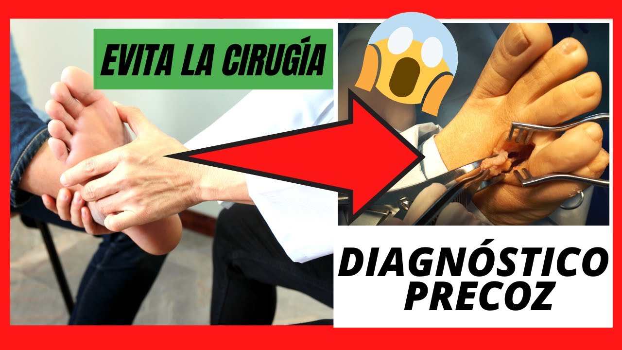 ¿Cómo Saber si Tengo un NEUROMA DE MORTON? 🤯 🤔 [Dónde Duele Y Cómo se ...