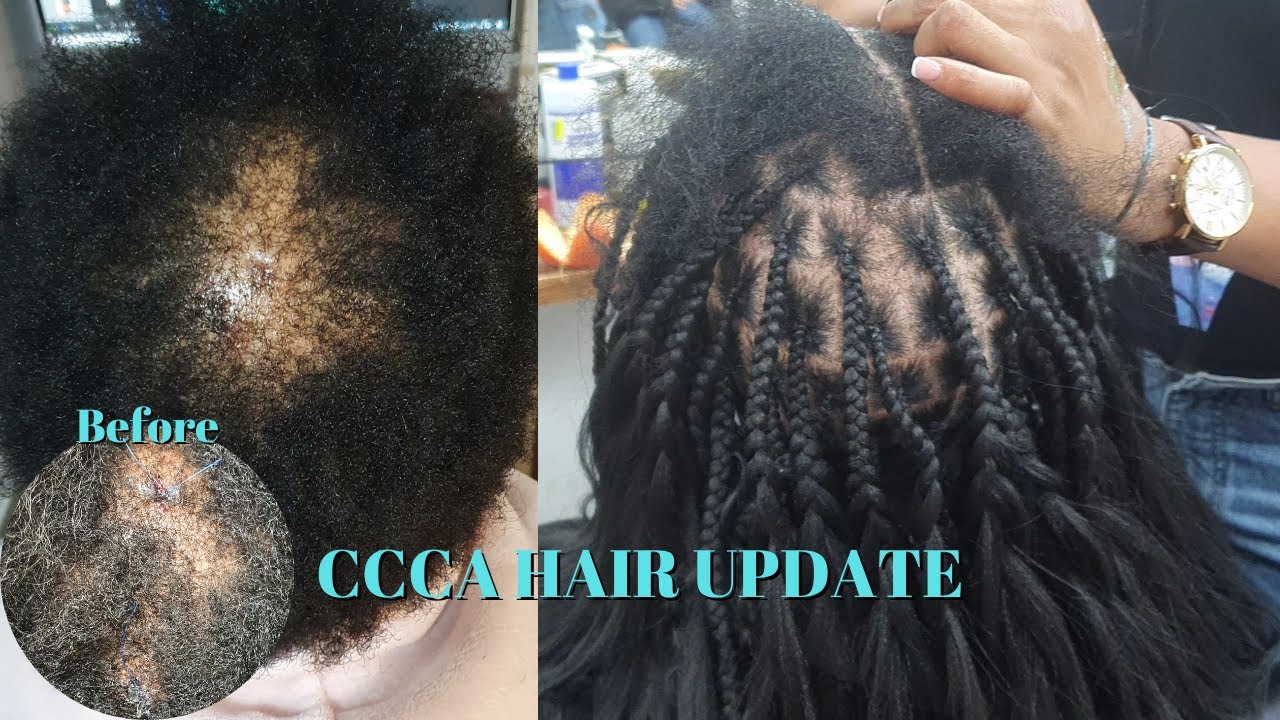 CCCA Hair Loss Update - See The Latest Styling Option + What to do if ...