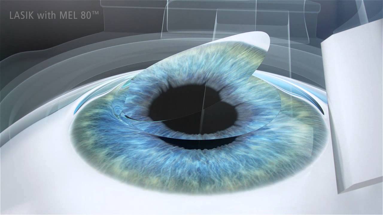 Laser Surgery - Zeiss animation of Refractive Laser procedure called ...