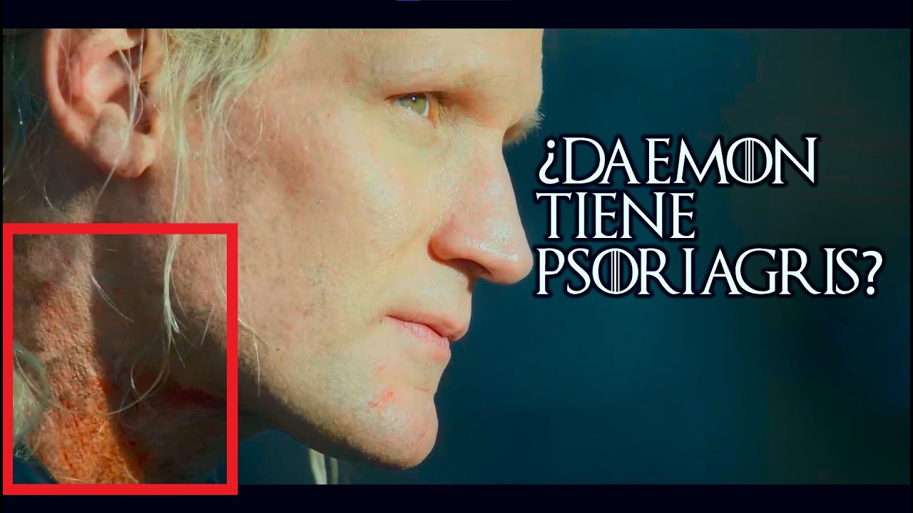¿DAEMON TARGARYEN se contagió de PSORIAGRIS? House Of The Dragon La ...