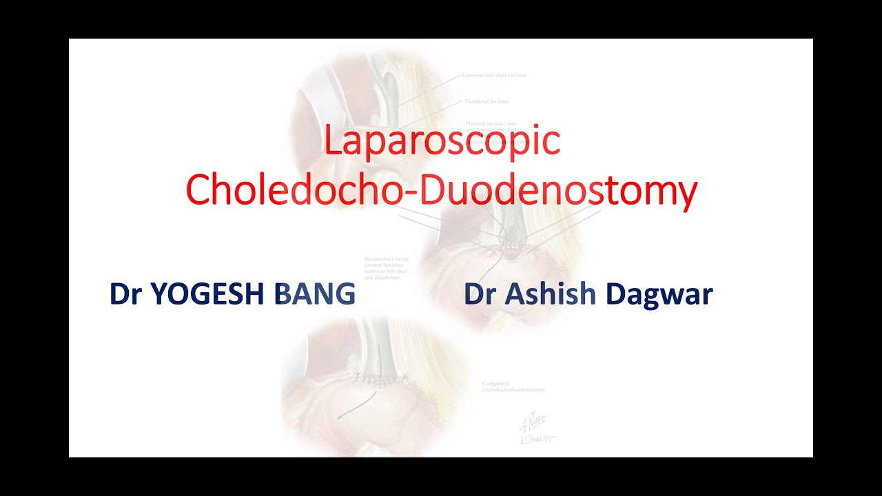 LAPAROSCOPIC CHOLEDOCHO-DUODENOSTOMY - YouTube