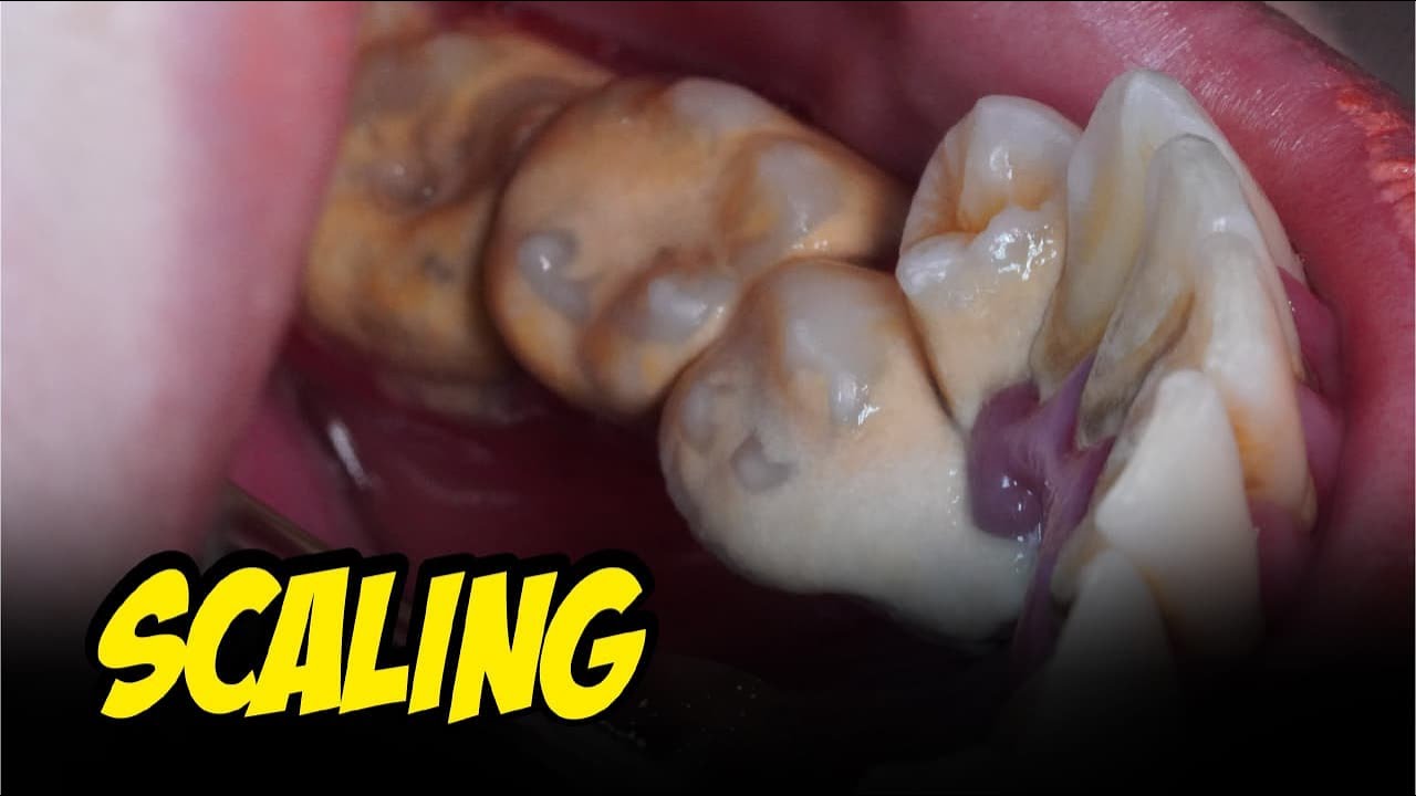 24yo. Female. SCALING | TARTAR | Dentist | Dokter Gigi Tri Putra - YouTube