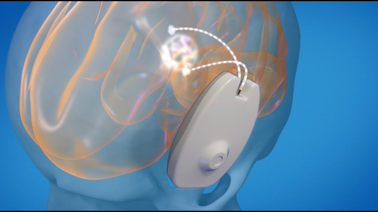 CraniUS introduces NeuroPASS: World’s first skull-embedded device for ...