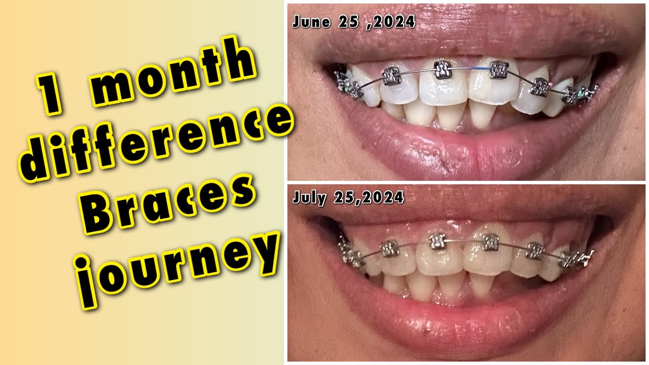 Braces Update : 1 month on braces. Is there some changes? - YouTube