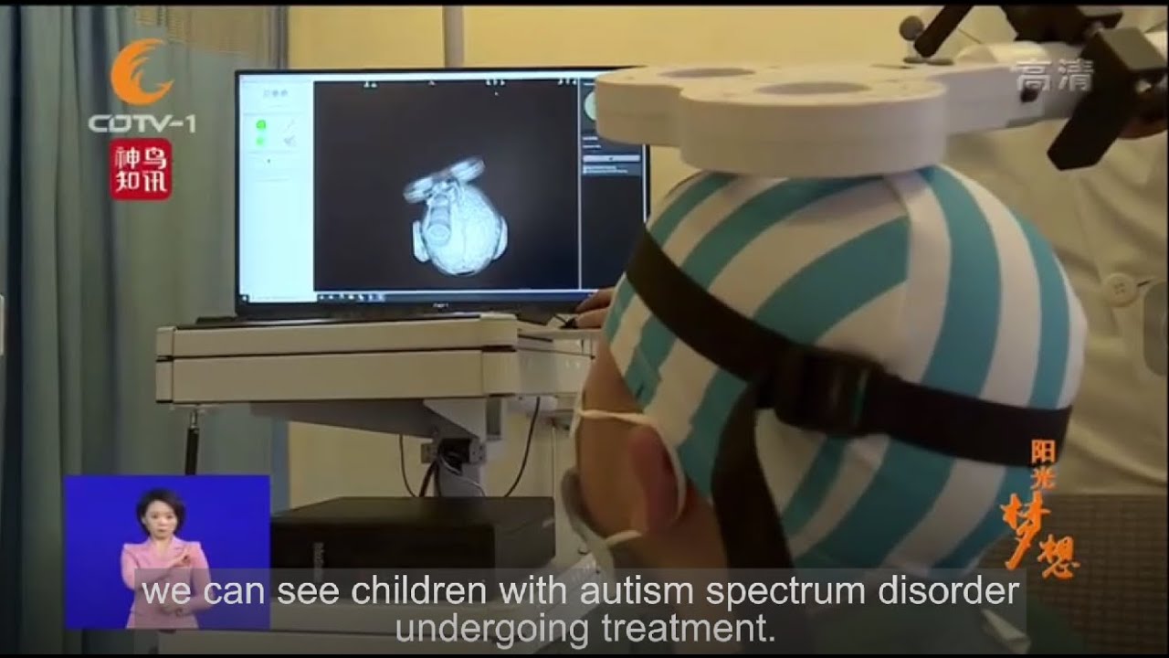 TMS Therapy in Autism Spectrum Disorder: Light up Hope for Numerous ...