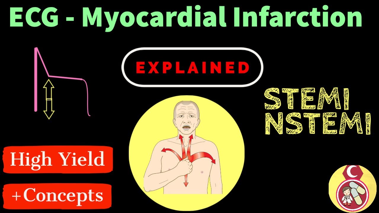 ECG Crash course - #14 Myocardial Infarction (STEMI - NSTEMI) - YouTube