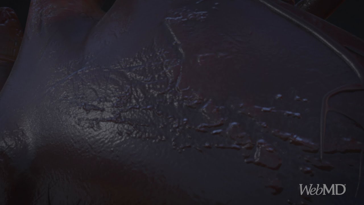 Inside a Widow-Maker Heart Attack | WebMD - YouTube