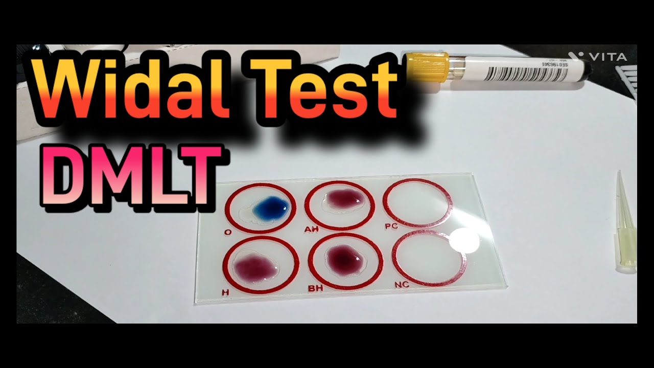 Widal Test procedure (Typhoid Test)/Fully explained/ DMLT #dmlt # ...
