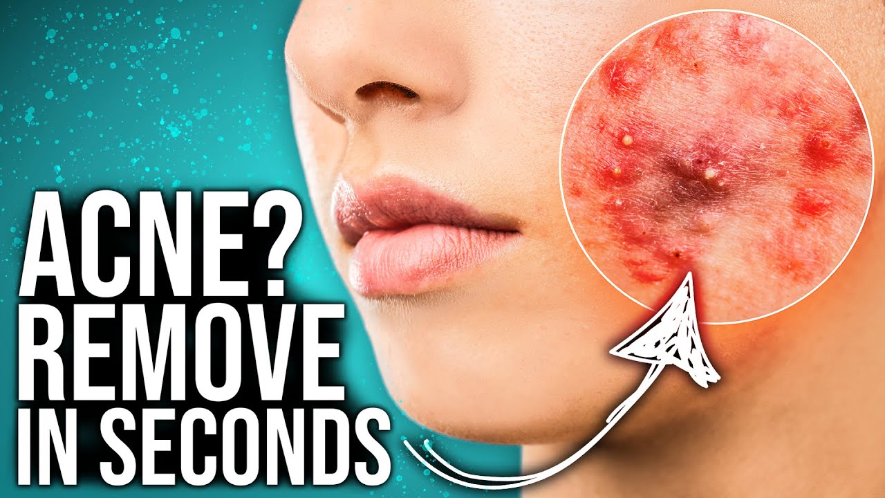 7 Weird Ways To Treat Acne - YouTube
