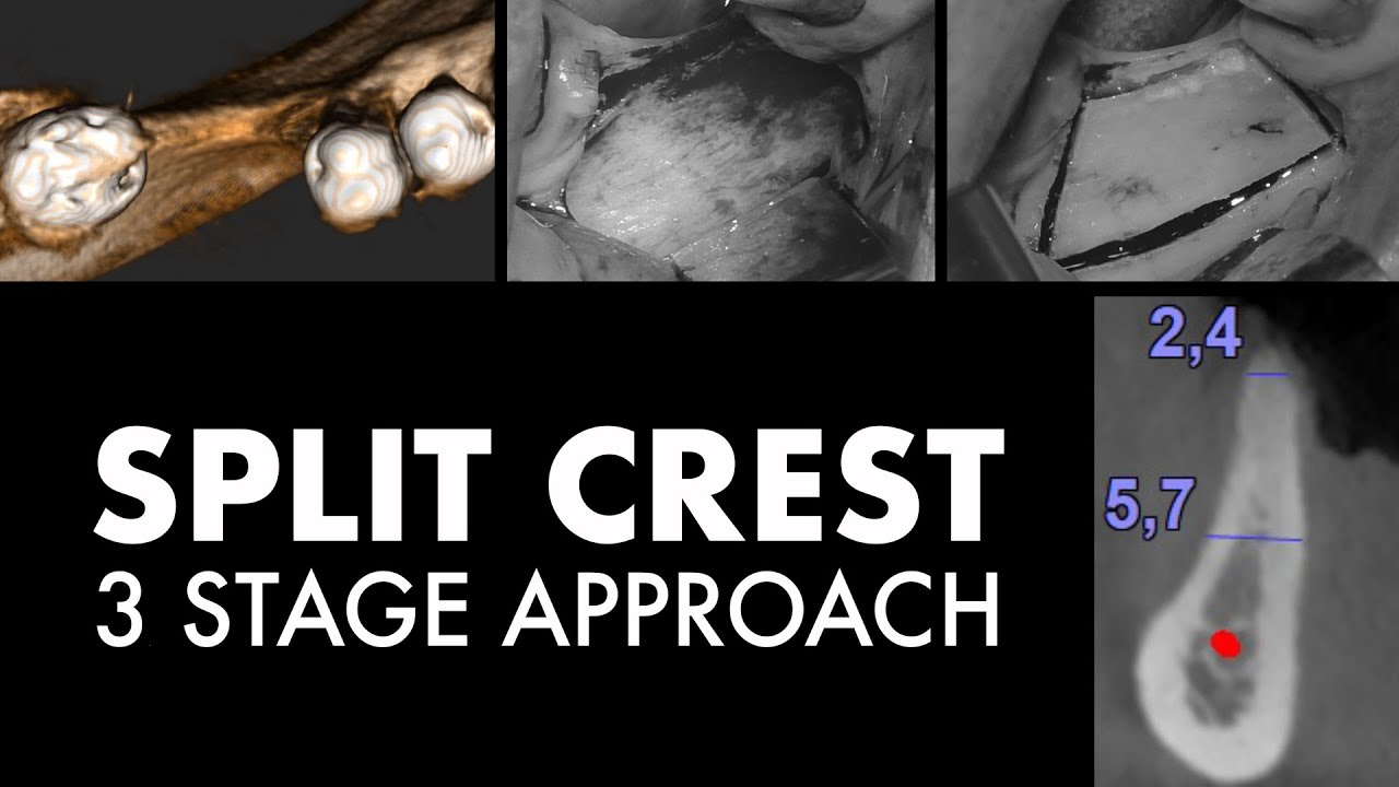 Split Crest - 3 Stages - YouTube