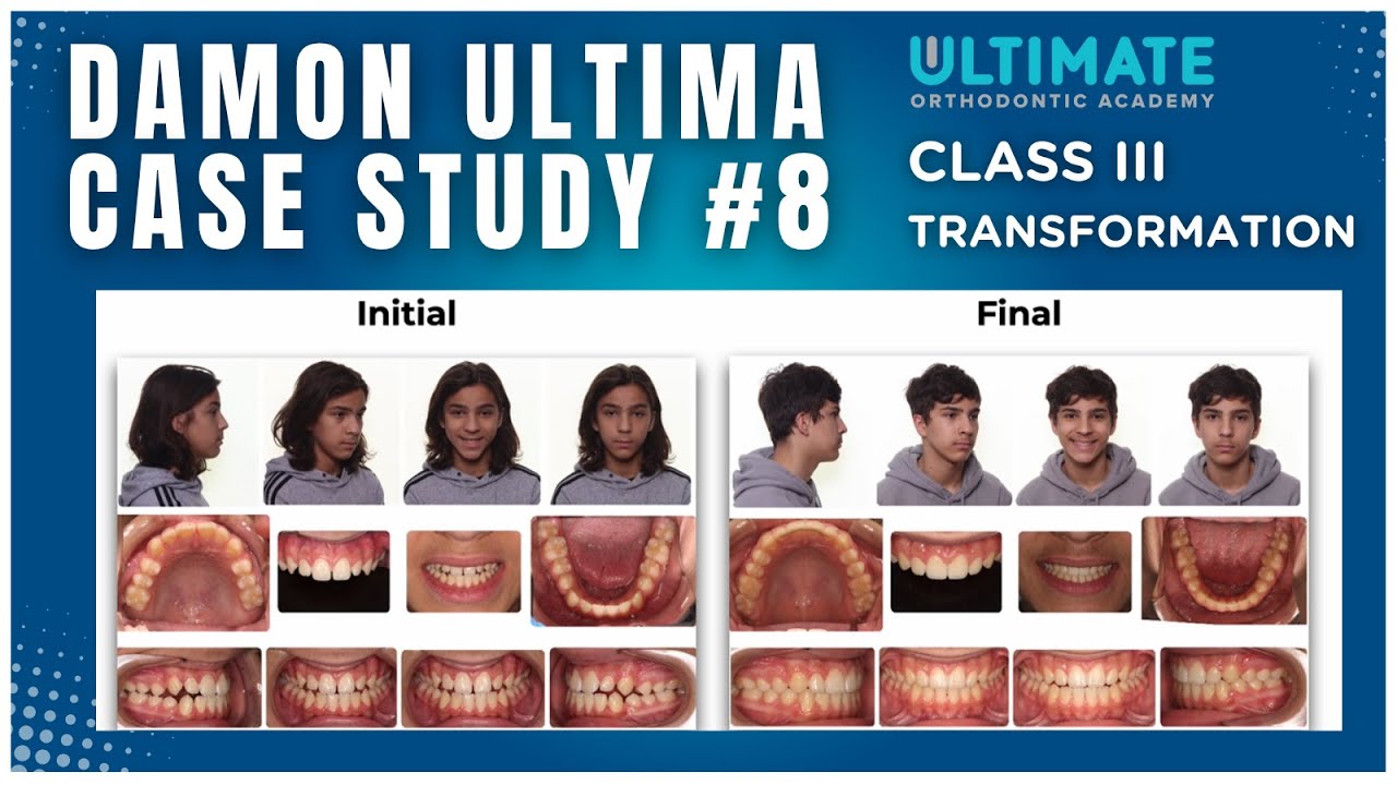 14 Month Class III Transformation: Damon Ultima Case Study #8 - YouTube
