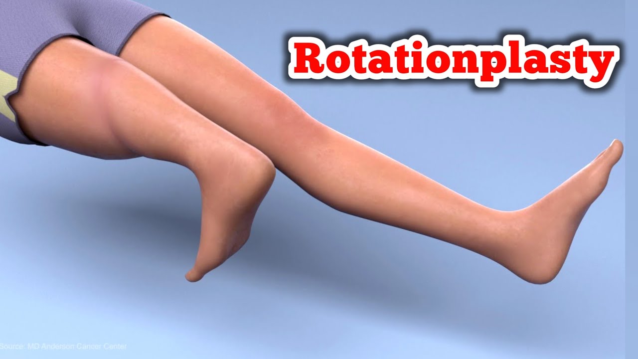 ماهي عملية التجميل الدورانية للرجل (اغرب عمليات التجميل) _ ?What is a ...