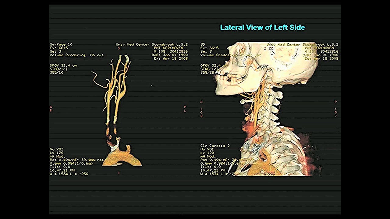 Radiology of the Neck ( with optional subtitles) - YouTube