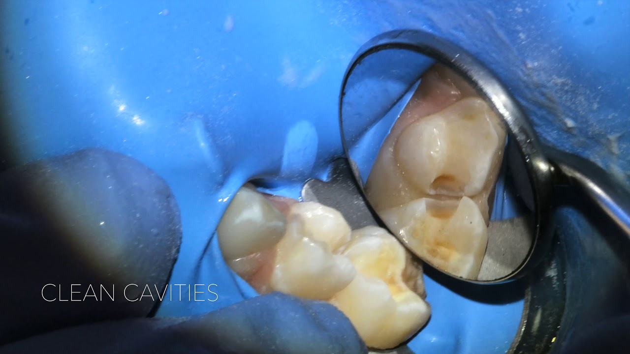 Primary molars class II cavities - YouTube