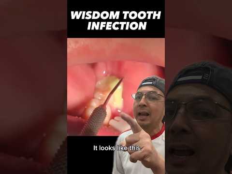 What Is Wisdom Teeth Abscess