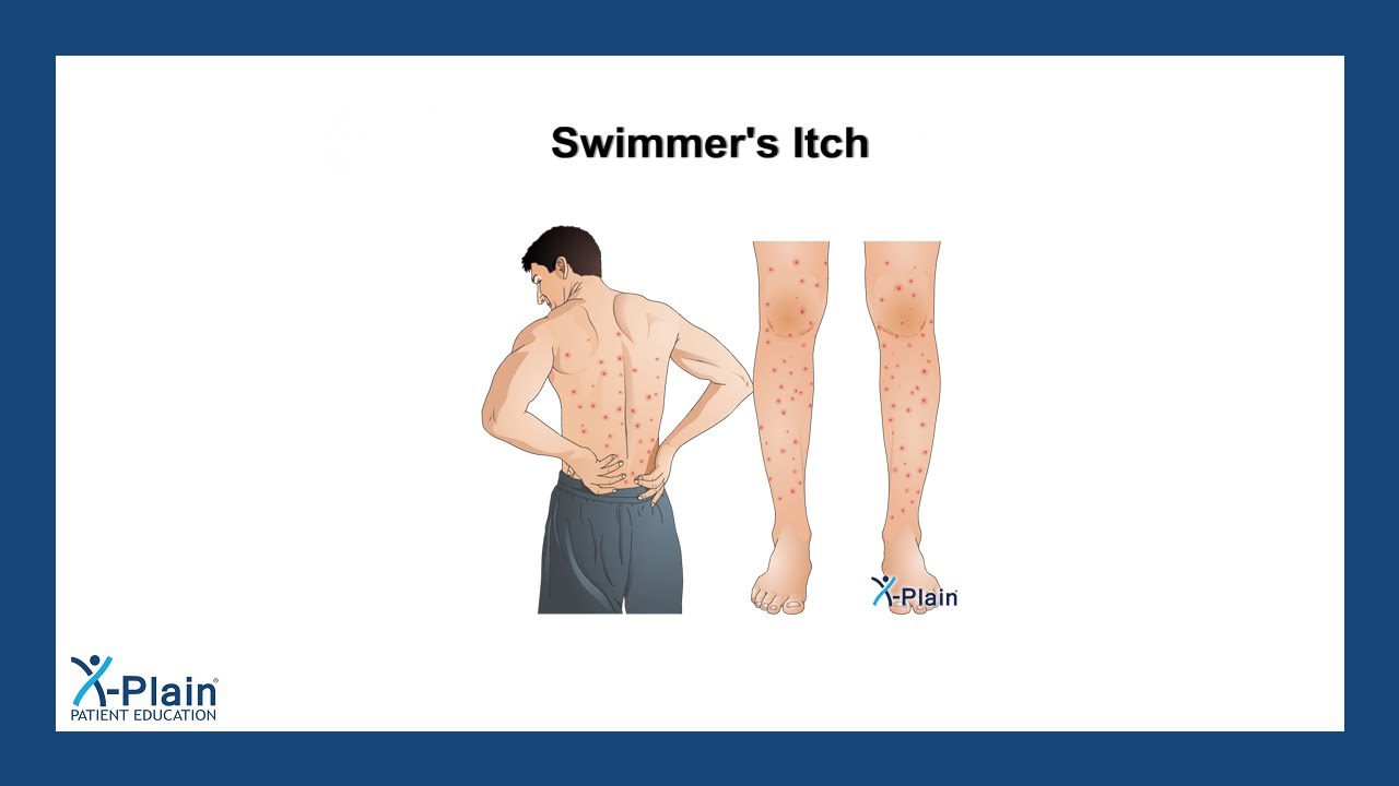 Swimmer's Itch - YouTube