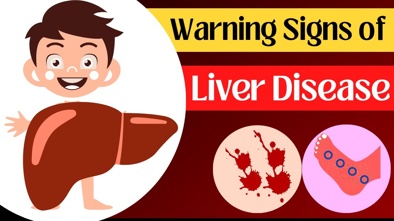 Liver Disease Signs and Symptoms | Warning Signs of Liver | - YouTube