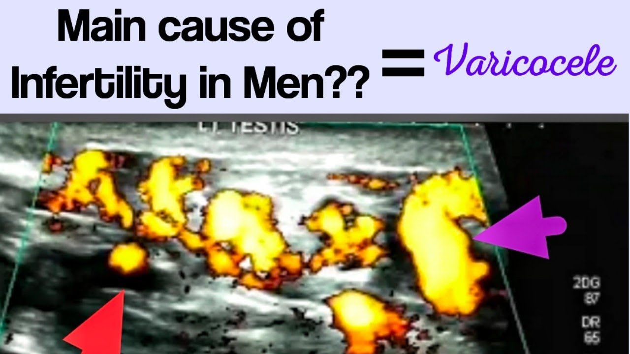What is Main Cause of Infertility in Men ? ..... Varicocele? | Orchitis ...