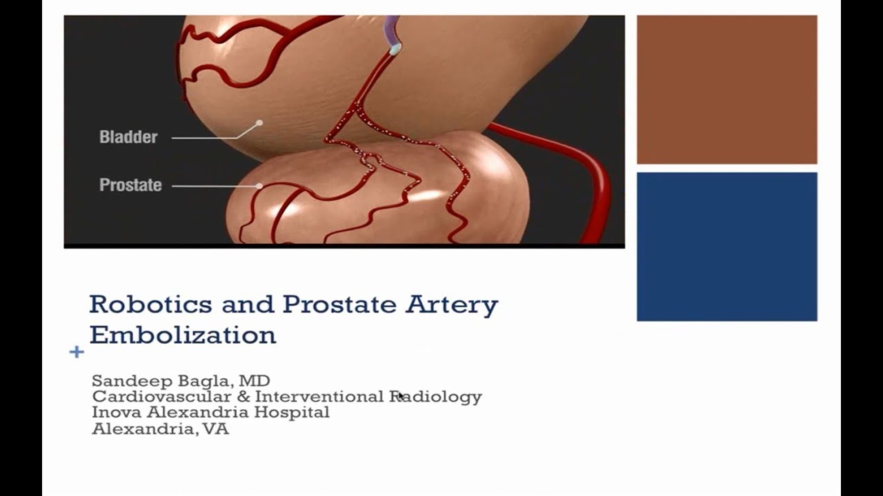 Advantages of Prostate Artery Embolization with the Magellan Robotic ...