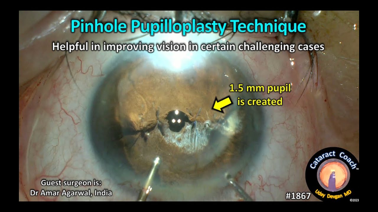 CataractCoach™ 1867: pinhole pupilloplasty technique - YouTube