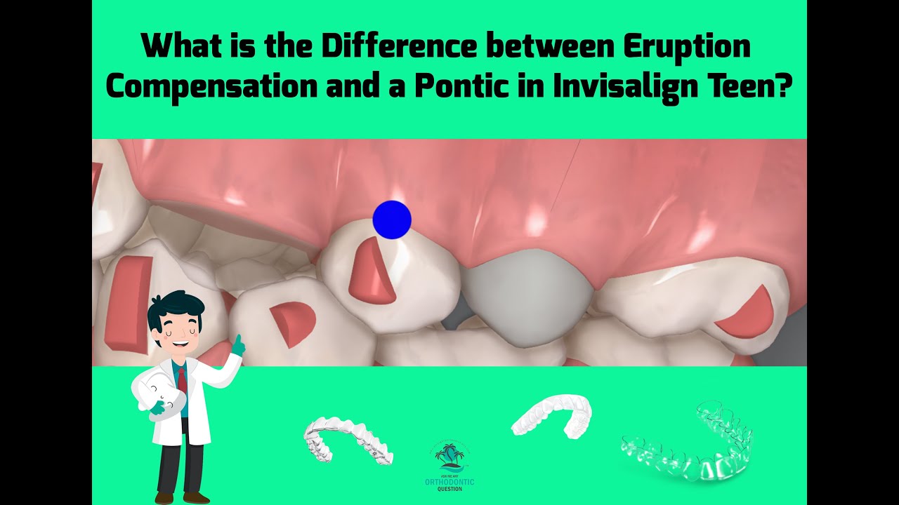 What is the Difference between Eruption Compensation and a Pontic in ...