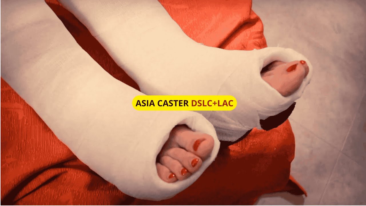 Asia broken cast DSLC+LAC - YouTube