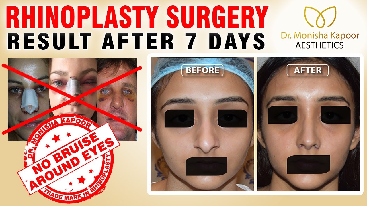 Preservation Rhinoplasty Surgery Never Seen Before | Best Nose Job ...
