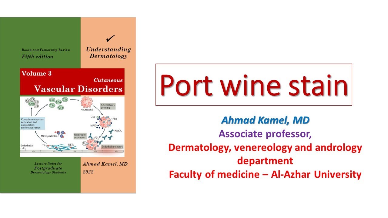 Port wine stain nevus - YouTube